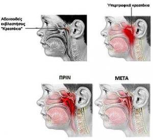 Hyperplasia of Adenoids | | mass of lymphoid tissue