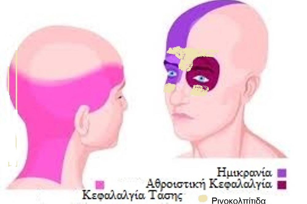 Κλινικός έλεγχος για Ημικρανία-Κεφαλαλγίες | ΕΥίασις – ΩΡΛ Ενηλίκων και ...